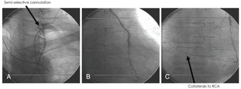 Semi Selective Angiography Of A Left Mammary Graft With A Modified Download Scientific Diagram