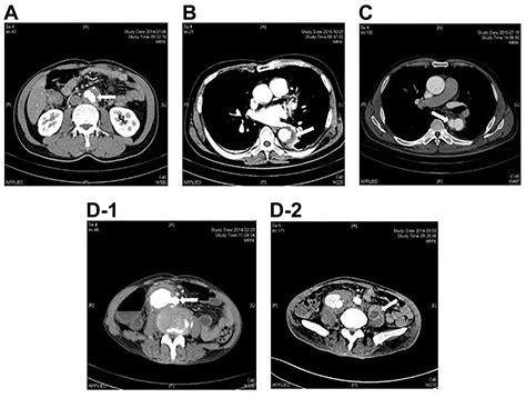 Mycotic Aortic Aneurysm