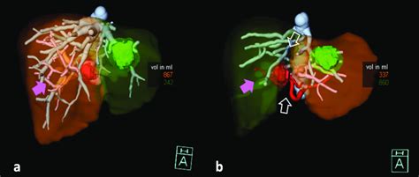 Associating Liver Partition And Portal Vein Ligation For Staged Download Scientific Diagram