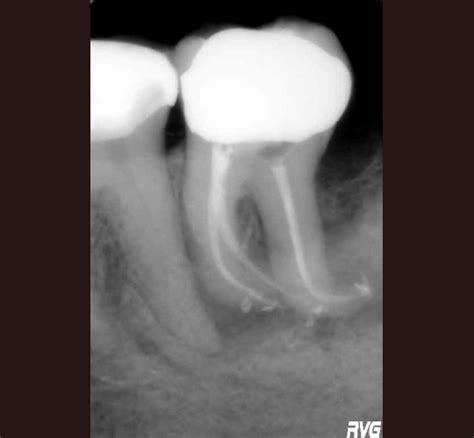 Endodontic Treatment Case 4 Patient Presented For Root Canal Therapy Referred To Our Office