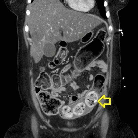 Coronal View Computed Tomography With Intravenous Contrast