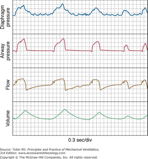Proportional Assist Ventilation Anesthesia Key