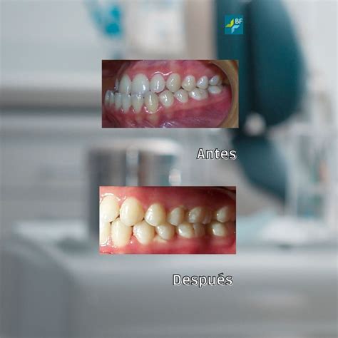 Procedimientos Quirúrgicos Clase III | BFEstéticaDental