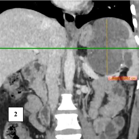 Plain Axial Ct Of The Cyst Showing Areas Of Relative Hyperdensity And Download Scientific
