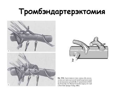 Хирургическое лечение тромбоза мезентеральных сосудов - презентация онлайн