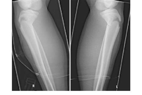 Trauma Bilateral Proximal Tibia Fracture Download Scientific Diagram