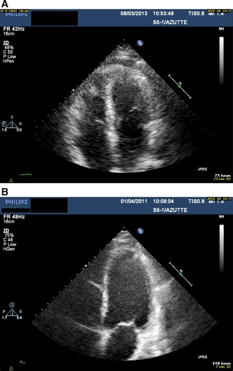 End Stage Cardiomyopathy Because Of Hereditary Hemochromatosis