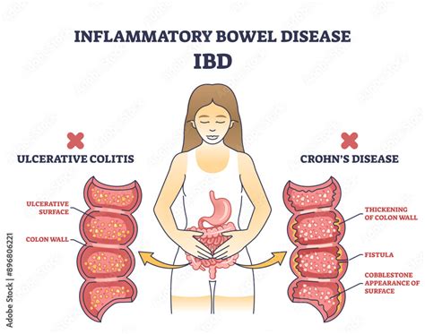 Inflammatory Bowel Disease Or Ibd With Crohns Condition And Ulcerative