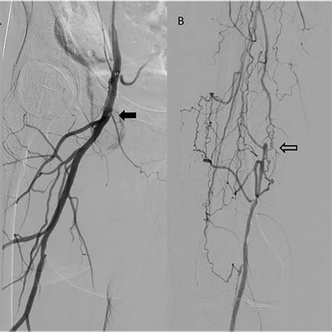 What Is Occlusion Of Sfa At John Jessep Blog