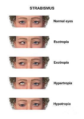 Strabismus Photos For Sale Fine Art America