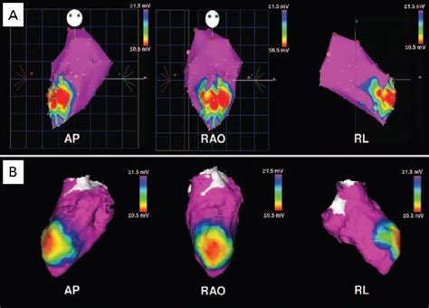 The First Published Example Of Electroanatomic Mapping Style Interface Download Scientific