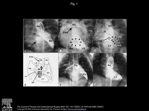An Arterial Switch Operation For A Concordant Crisscross Heart With The Complete Transposition