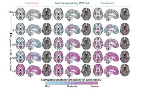 New Multiple Sclerosis Subtypes Identified Using Artificial
