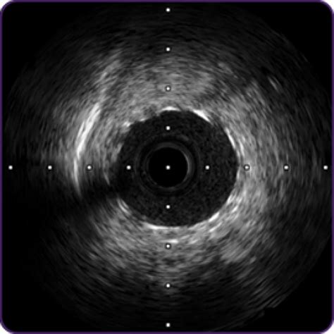 Complex Pci Ivus Catheter Opticross Boston Scientific