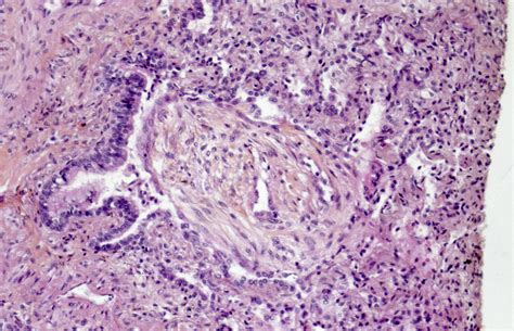 Cryptogenic Organising Pneumonia Stock Image C0618577 Science