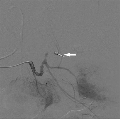 Post Embolization Angiogram Demonstrating Coils In Segmental Branch Of
