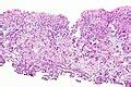 Signet Ring Cell Carcinoma Libre Pathology