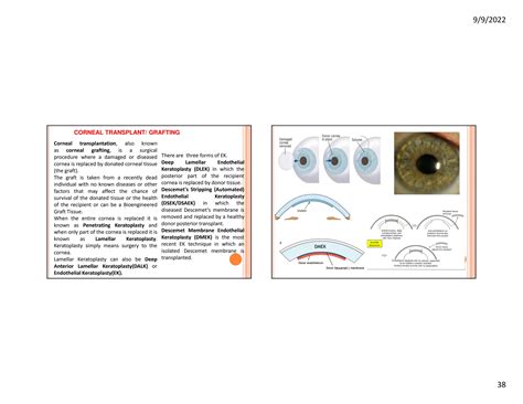 Cornea Stricture And Disorders In The Eye Ppt