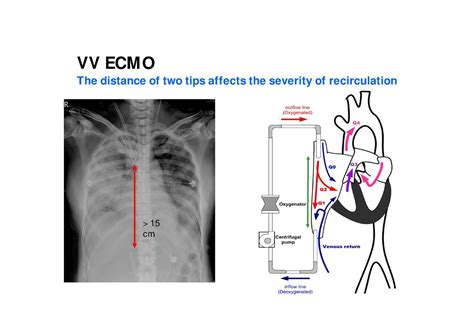 Ecmoconfiguration1