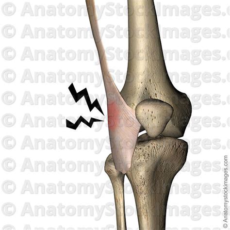 Lateral Epicondyle