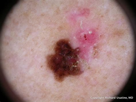 Melanoma