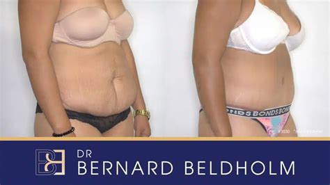 Abdominoplasty Post Pregnancy Patient 3030