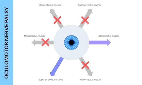 Premium Vector Oculomotor Nerve Palsy