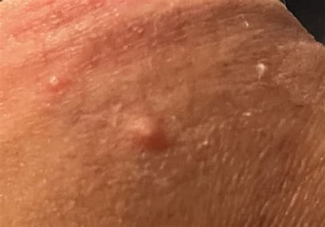 How To Prevent Genital Warts And Where They Can Spread