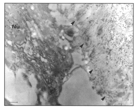 Immunoelectron Microscopy Of An Osteoblastic Osteosarcoma Using Download Scientific Diagram