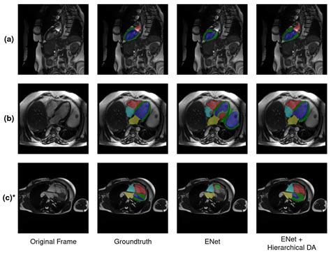 Effect Of Data Augmentation On Deep Learning Based Segmentation Of Long Axis Cine Mri