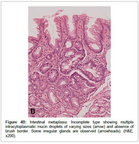 The Gastric Precancerous Cascade