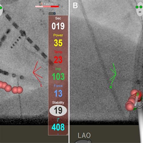 Ablation Index Guided Cavotricuspid Isthmus Ablation In Fluoroscopy Download Scientific Diagram