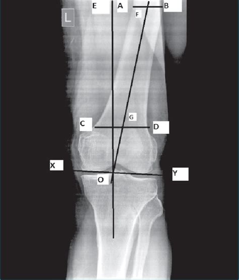 Showing Bicondylar Angle Download Scientific Diagram