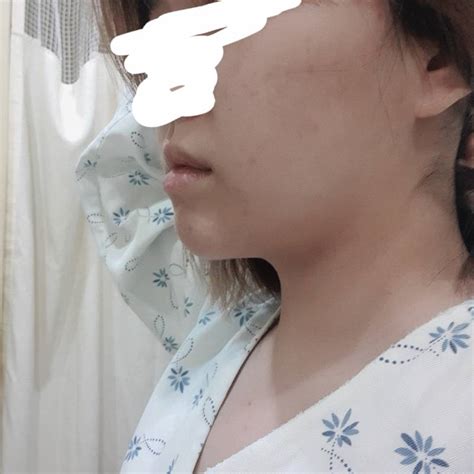 얼굴 지방흡입 후기 인스티즈instiz 뷰티 카테고리