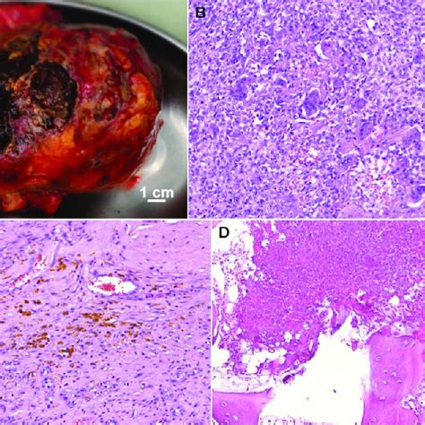 A Surgical Defect After En Bloc Subtotal Sternectomy For Gtc Tumor Of