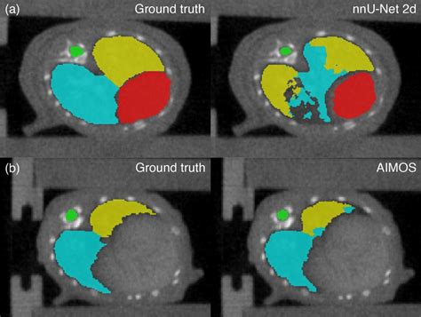 predictions of a nnu net 2d and b aimos on contrast enhanced cts