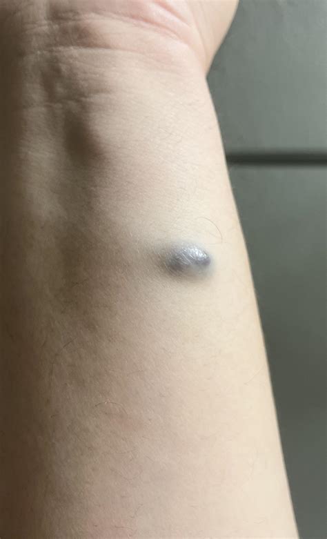 Palmoplantar Keratoderma Treatment Options R Dermatologyquestions