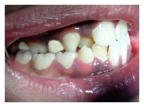 Lateral Intraoral View Showing Anterior And Posterior Crossbite On The