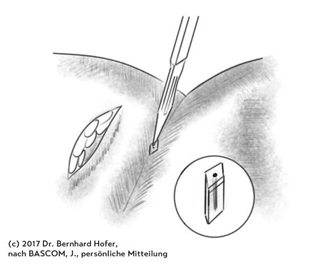 Pit Picking Operationstechnik Pilonidal Sinus Zentrum München