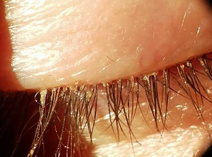 Demodex Blepharitis Blepharitis And Demodex Spp Infection Kot