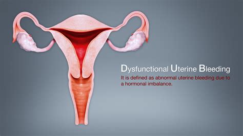 Dysfunctional Uterine Bleeding Symptoms Causes And Treatment