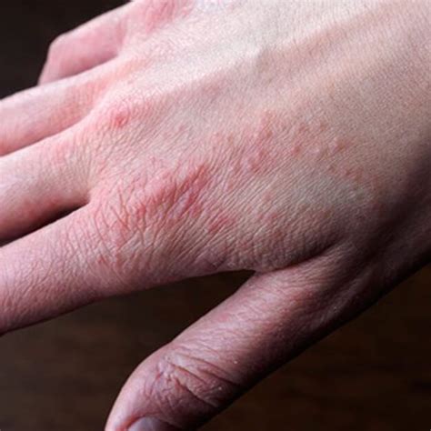 Холодовой дерматит 8 фото причины симптомы лечение заболевания Лостерин