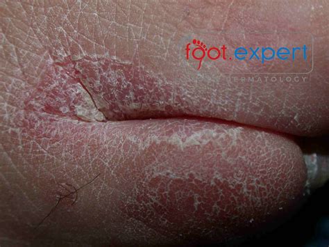 What Is The Id Reaction