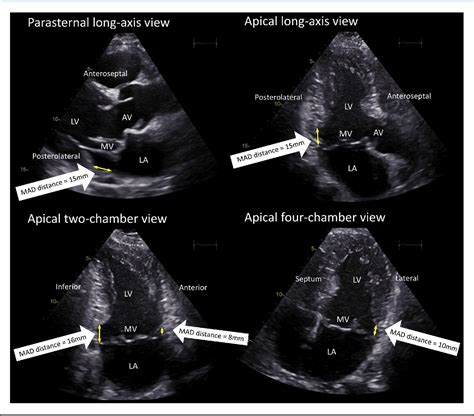 Figure 2 From The Mitral Annulus Disjunction Arrhythmic Syndrome Semantic Scholar