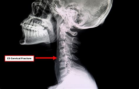 Neck Injuries Cervical Spine Anatomy Jacksonville Orthopaedic Institute