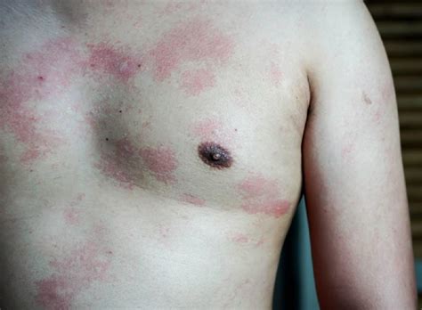 Foliculitis Síntomas Causas Y Tratamiento Blog Doctorgo