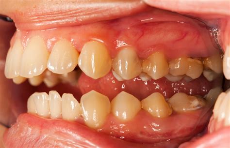 Moderate Gingivitis