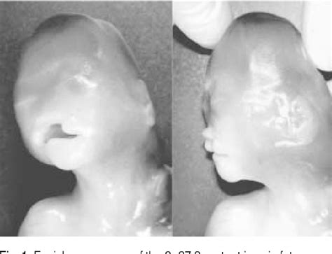 Figure 1 From Partial Trisomy 2q2q373 Qter And Monosomy 7q7q34