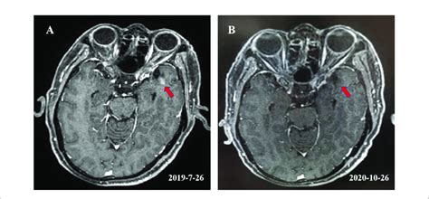 A Showed A Well Circumscribed Enhancing Nodular Lesion With A Download Scientific Diagram