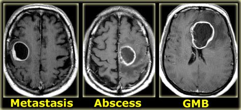 The Radiology Assistant Systematic Approach To Brain Tumors